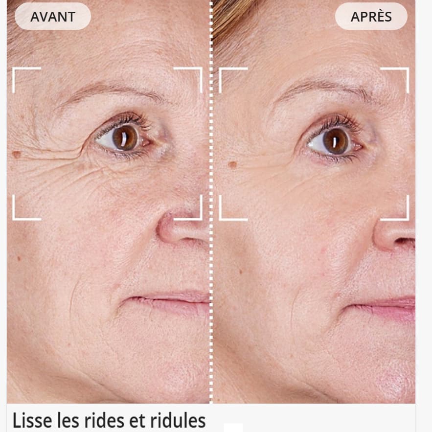 Comparatif des Avant/Après des masques à LED : revue complète et détaillée